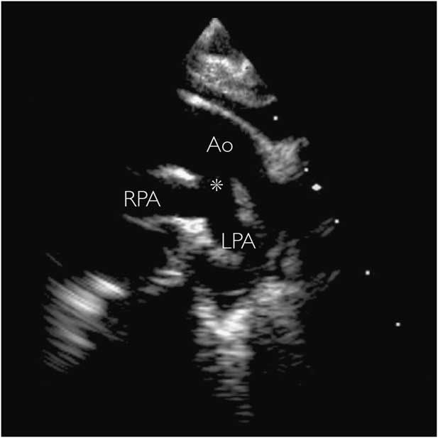 Persistent fifth aortic arch: the “great pretender” in clinical ...