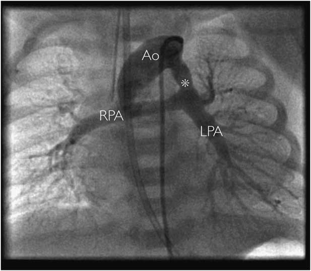 Persistent fifth aortic arch: the “great pretender” in clinical ...