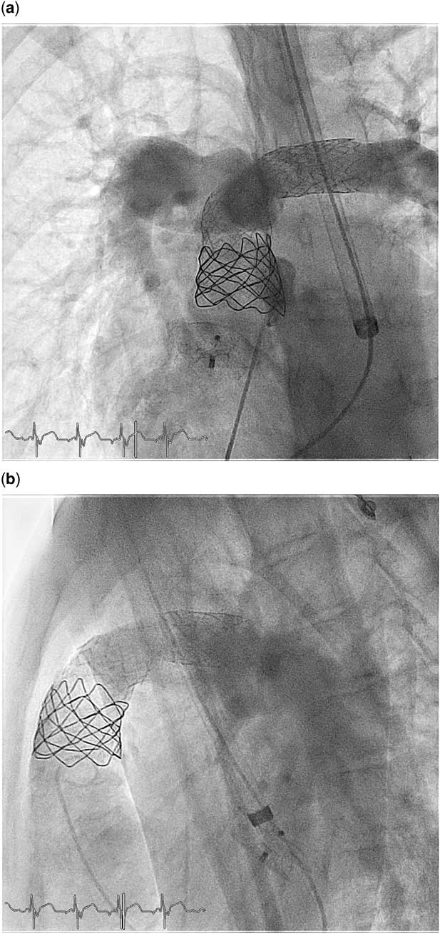 Is mesocardia with left-sided caval vein draining to coronary sinus a ...