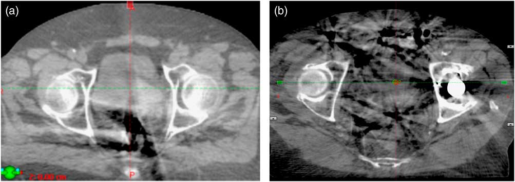 A feasibility study for the introduction of micro-enema to improve ...