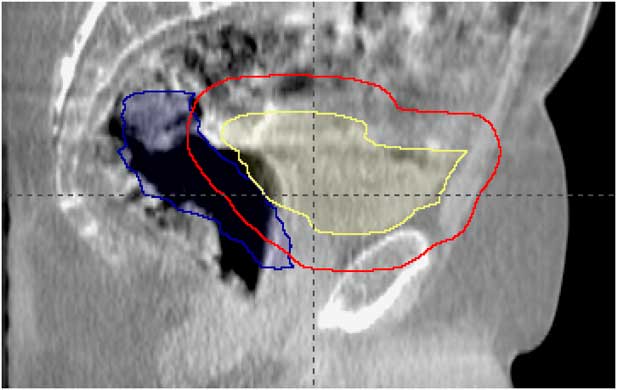 A feasibility study for the introduction of micro-enema to improve ...