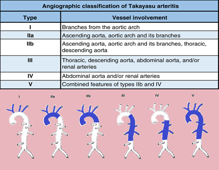 Takayasu arteritis in paediatrics | Cardiology in the Young | Cambridge ...