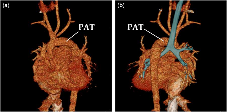 Repair of interrupted aortic arch using autologous pulmonary artery ...