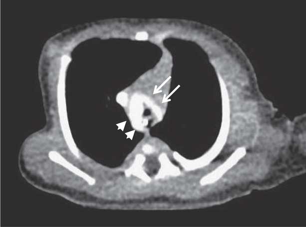 Double aortic arch presenting as neonatal respiratory failure in the ...