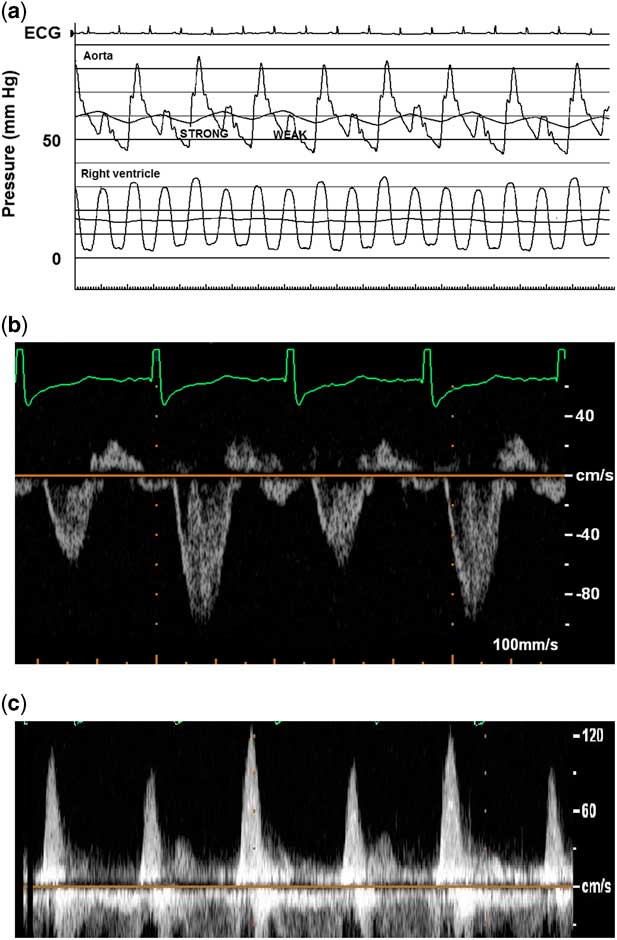 Pulsus alternans in a child with dilated cardiomyopathy | Cardiology in ...