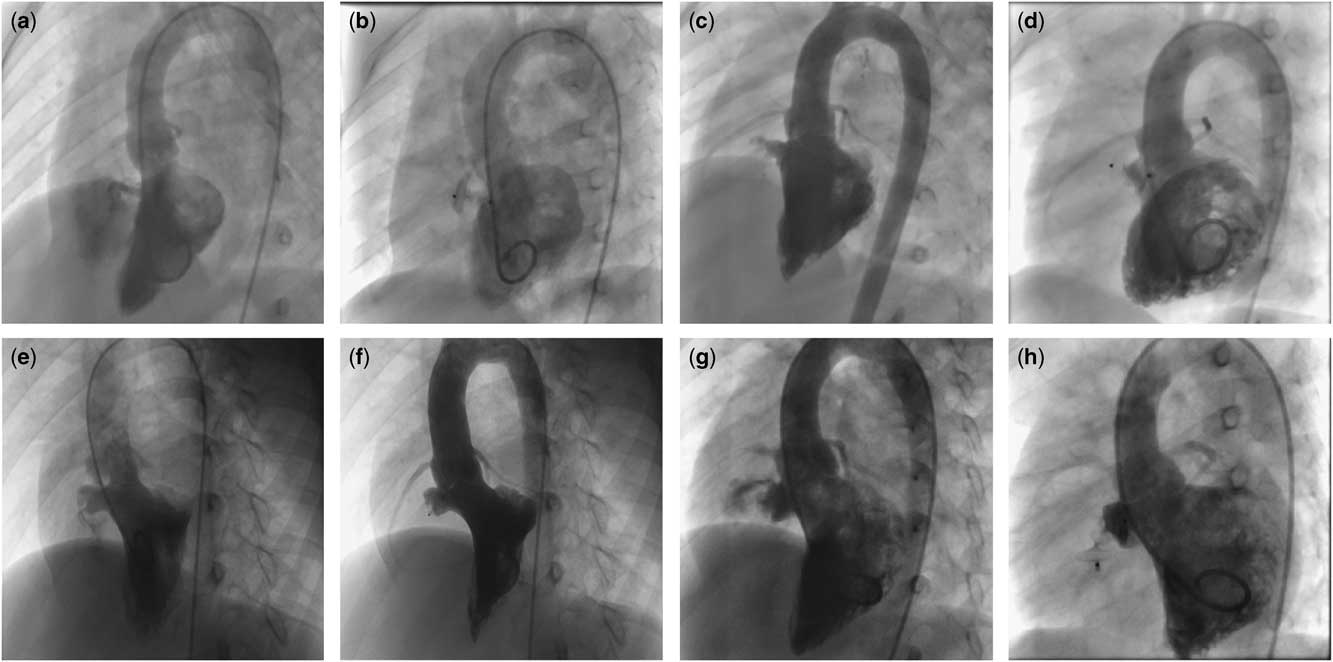 Transcatheter closure of congenital perimembranous ventricular septal ...
