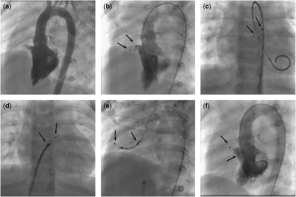 Transcatheter closure of congenital perimembranous ventricular septal ...