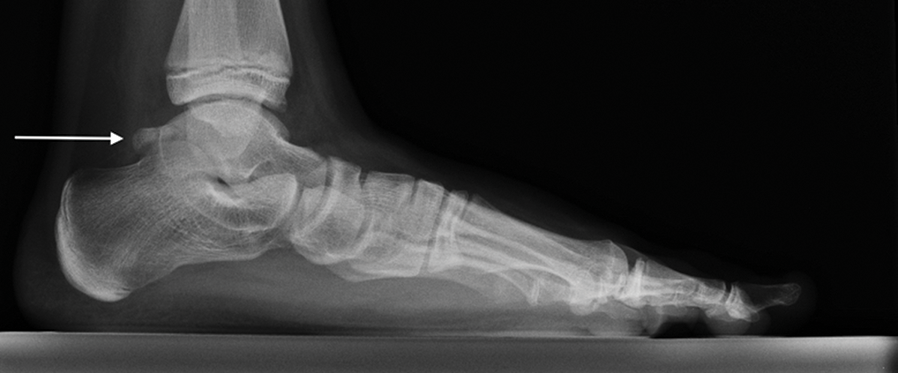 Normal Lateral Foot Xray
