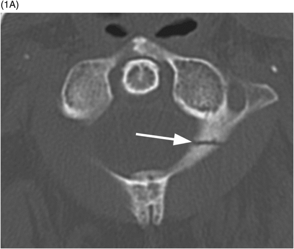 Posterior Neural Arch Fracture Posterior Neural Arch Fracture