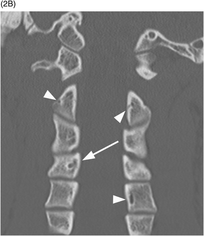 Vascular Channels (Grooves) and Normal Clefts (Case 1) - Clinical ...