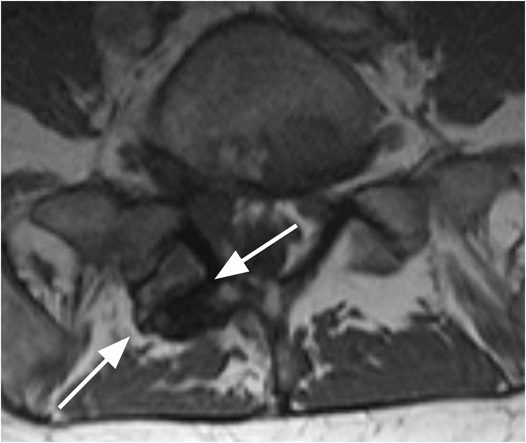 Vascular Channels (Grooves) and Normal Clefts (Case 1) - Clinical ...