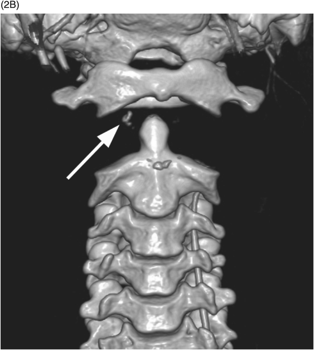 Atlanto Occipital Dislocation