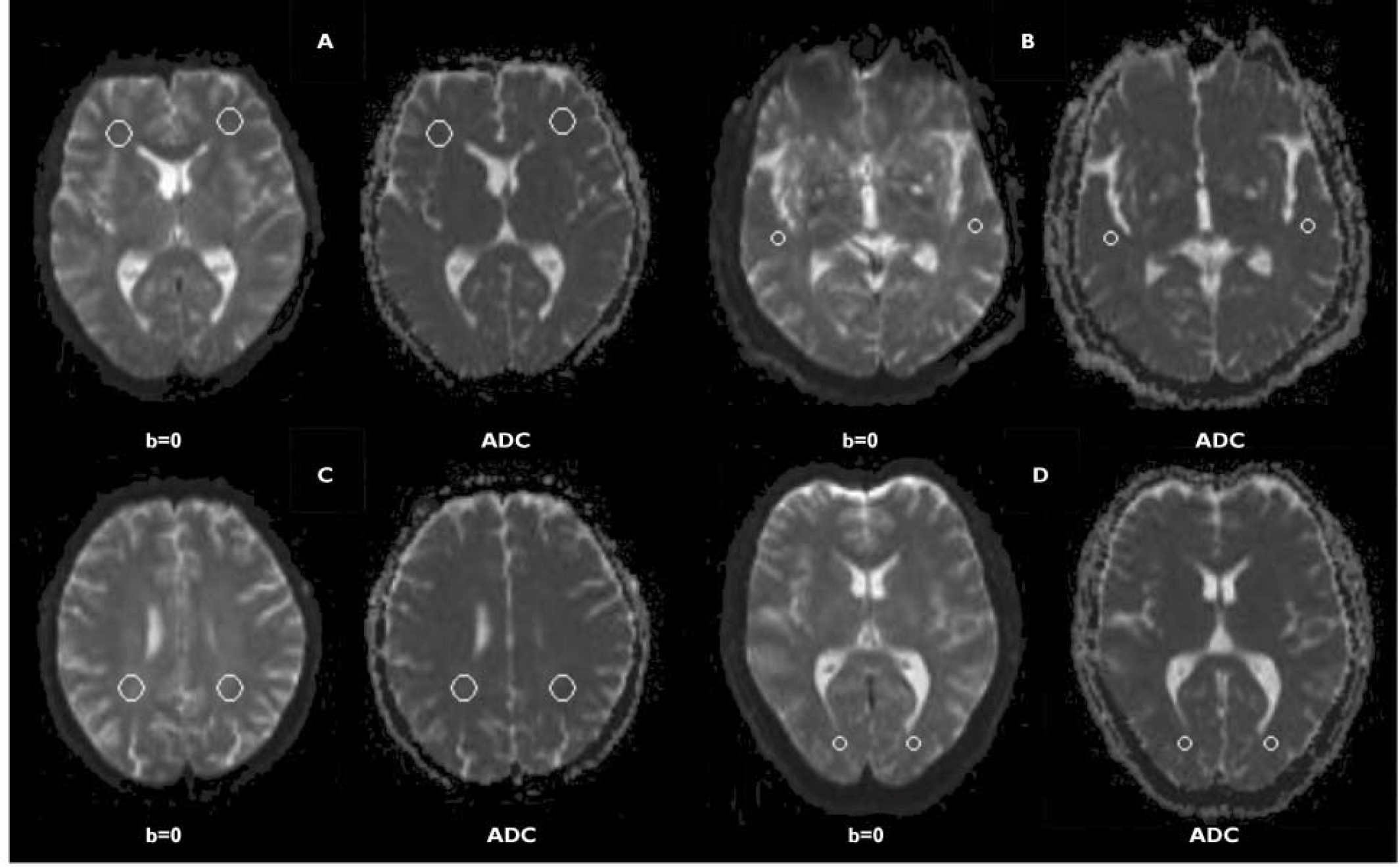 Cortical white-matter microstructure in schizophrenia | The British ...
