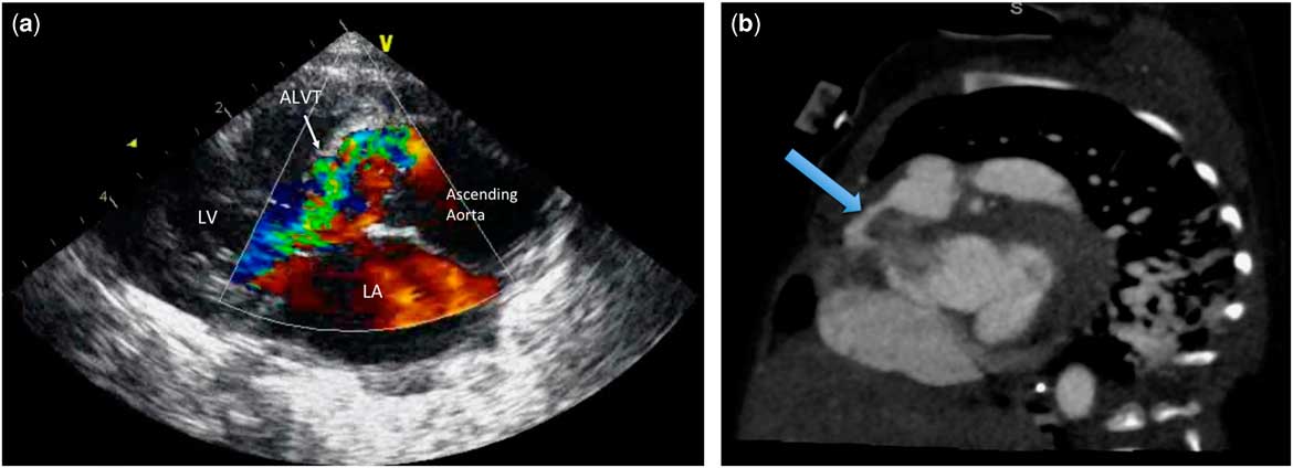 Large right ventricular sinusoids in an infant with aorta–left ...