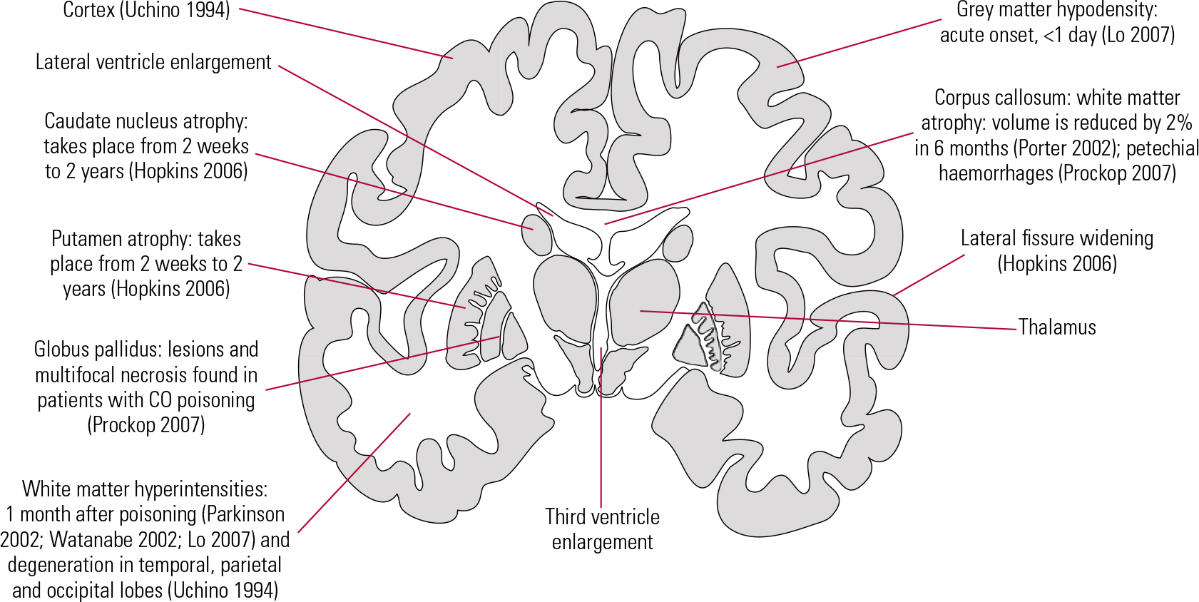Neuropsychiatric aspects of carbon monoxide poisoning: diagnosis and ...