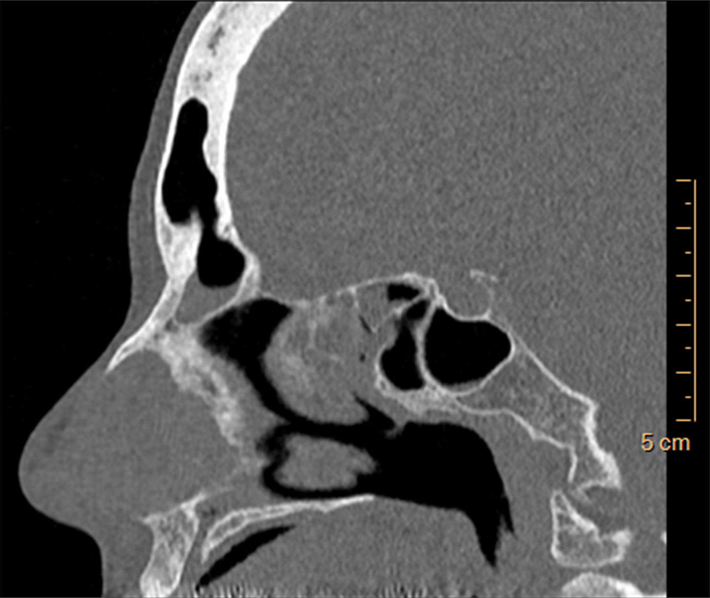 Fronto-septal rostrum: prevalence, classification and clinical ...
