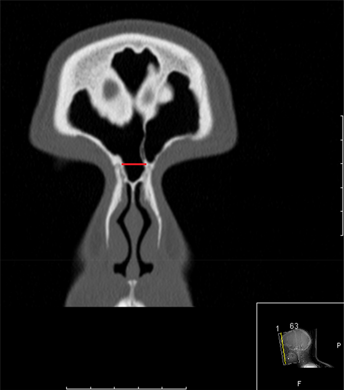 Fronto-septal rostrum: prevalence, classification and clinical ...