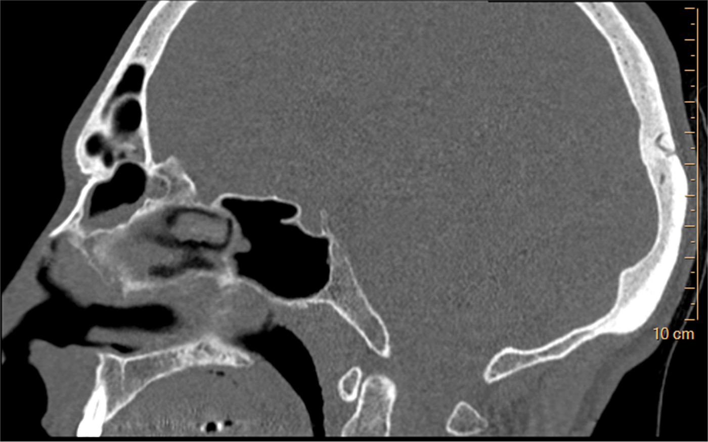 Fronto-septal rostrum: prevalence, classification and clinical ...