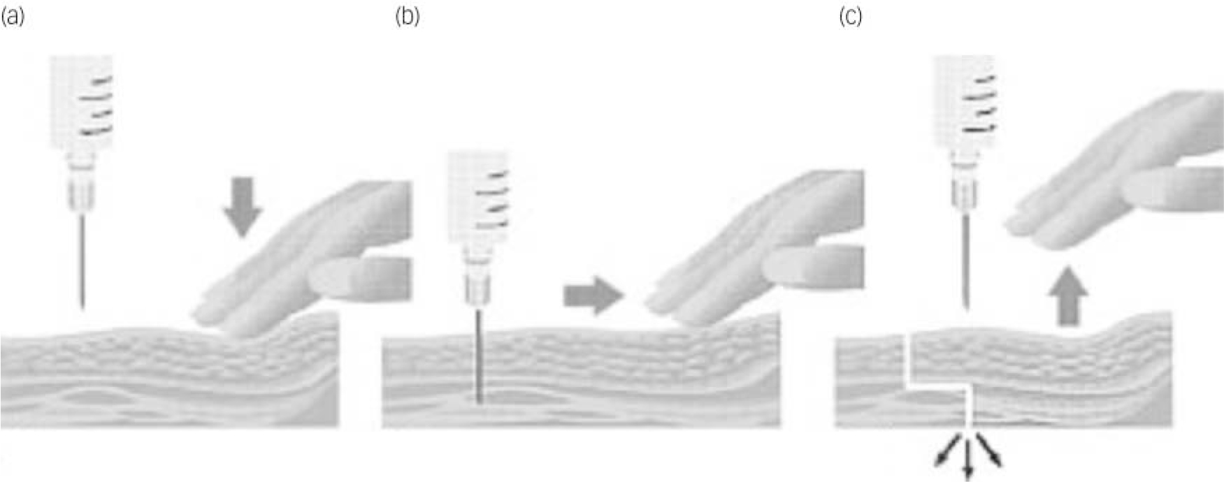 Antipsychotic long-acting injections in clinical practice: Medication ...
