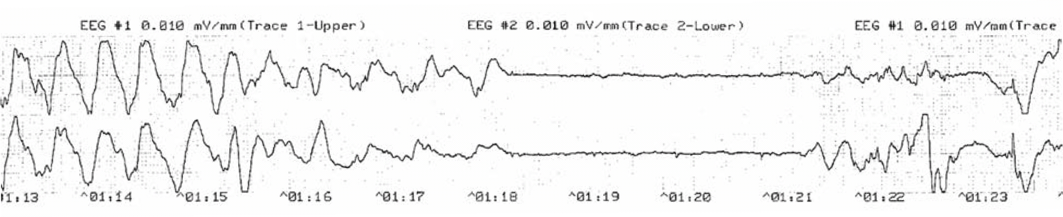 Monitoring electroconvulsive therapy by electroencephalogram: an update ...