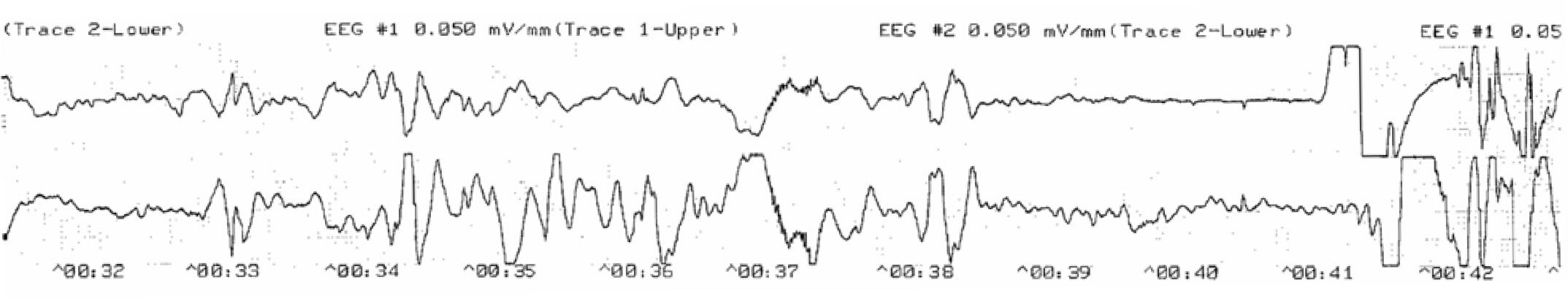 Monitoring electroconvulsive therapy by electroencephalogram: an update ...