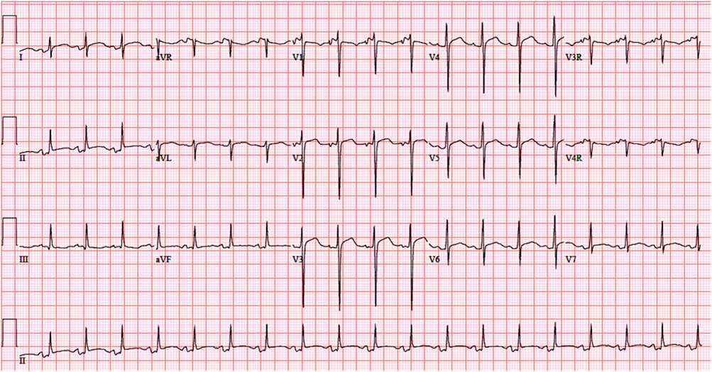 Intravenous sotalol use in a complex critically ill child: balancing ...