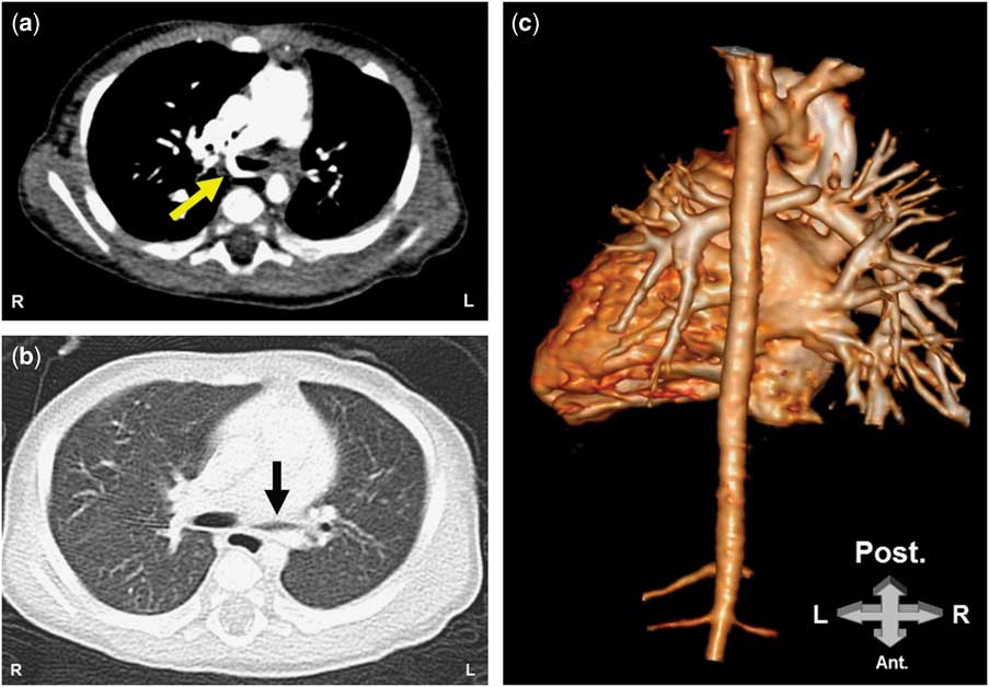 Incidental finding of pulmonary arterial sling during patent ductus ...