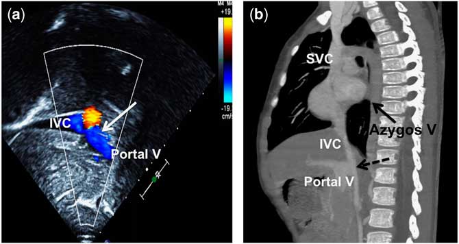 The Abernethy malformation with inferior caval vein hypoplasia: a ...