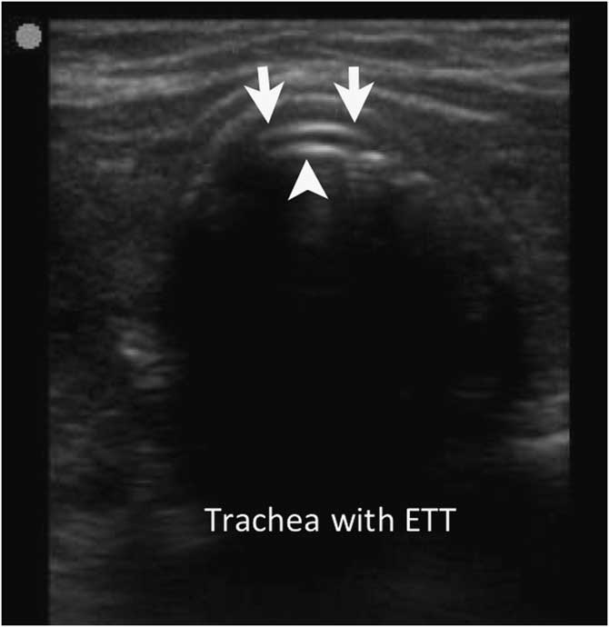 Avoid the Goose! Paramedic Identification of Esophageal Intubation by ...
