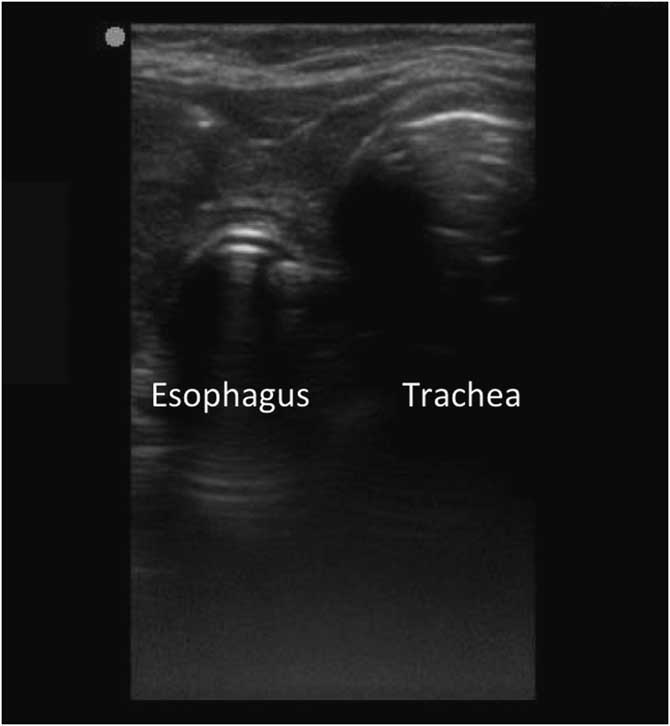 Avoid the Goose! Paramedic Identification of Esophageal Intubation by ...