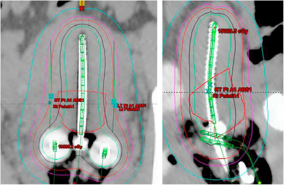 Dosimetric evaluation of tandem-based cervical high-dose-rate ...