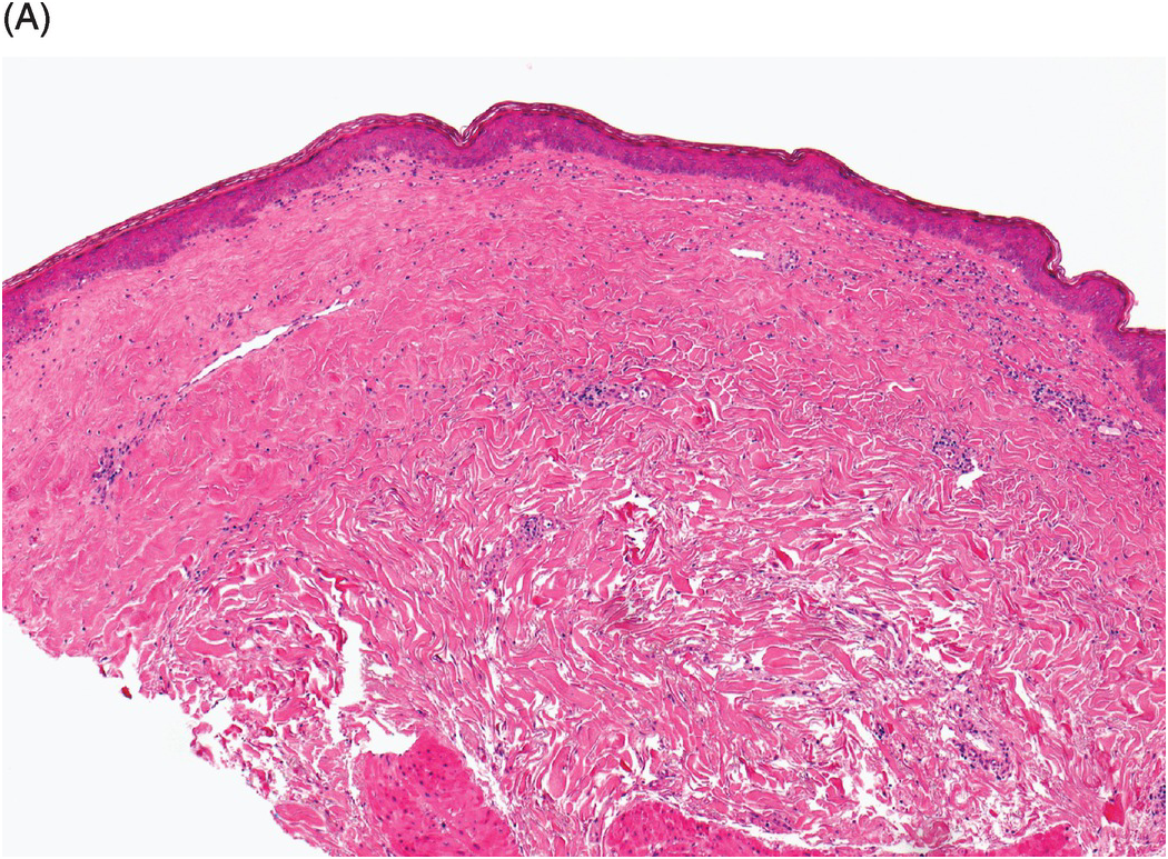 Nephrogenic Systemic Fibrosis Histology