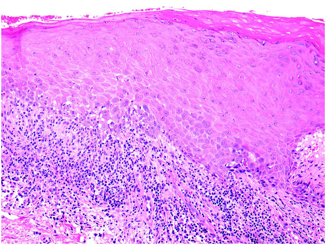 Lichen Simplex Chronicus Histology
