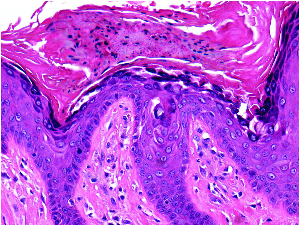 Bullous Pemphigoid Histology Labelled