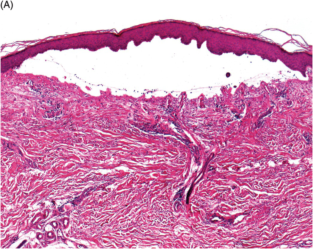 The Histologic Pattern Of Subepidermal Blisters With