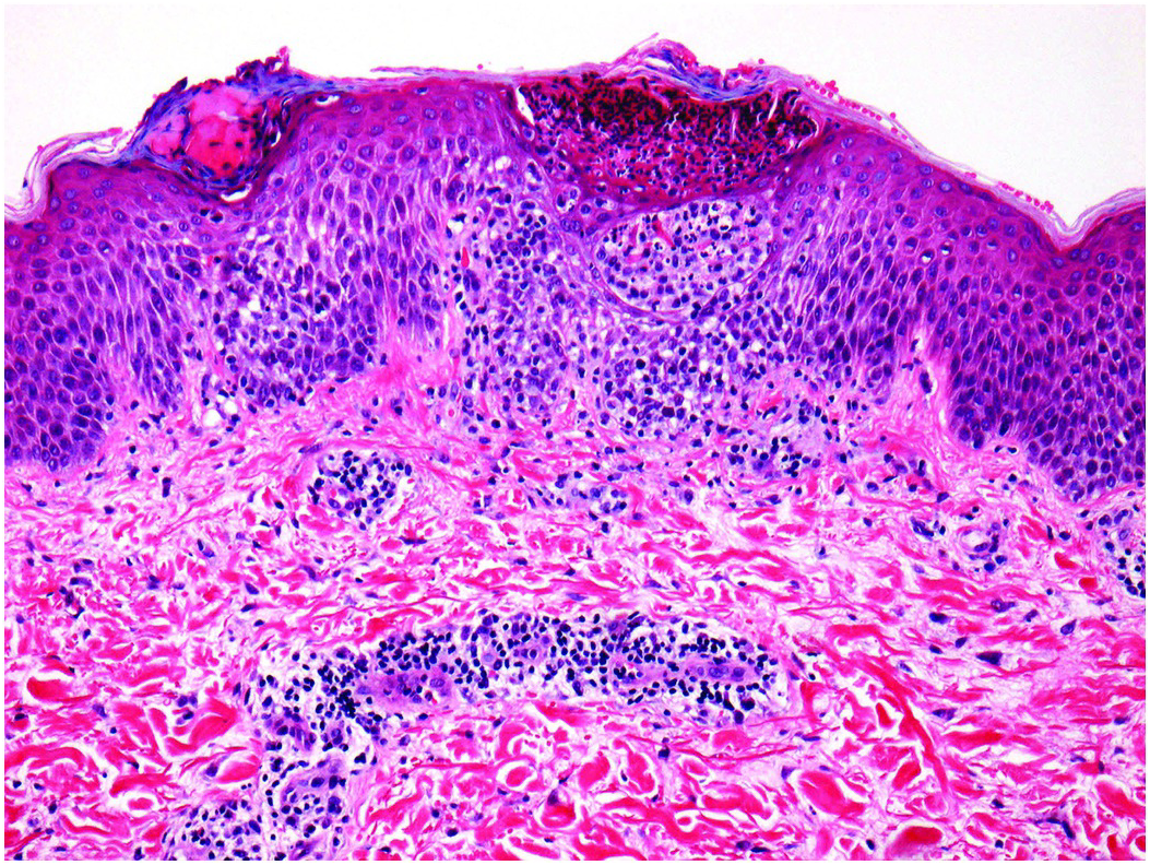Erythema Annulare Centrifugum Histology