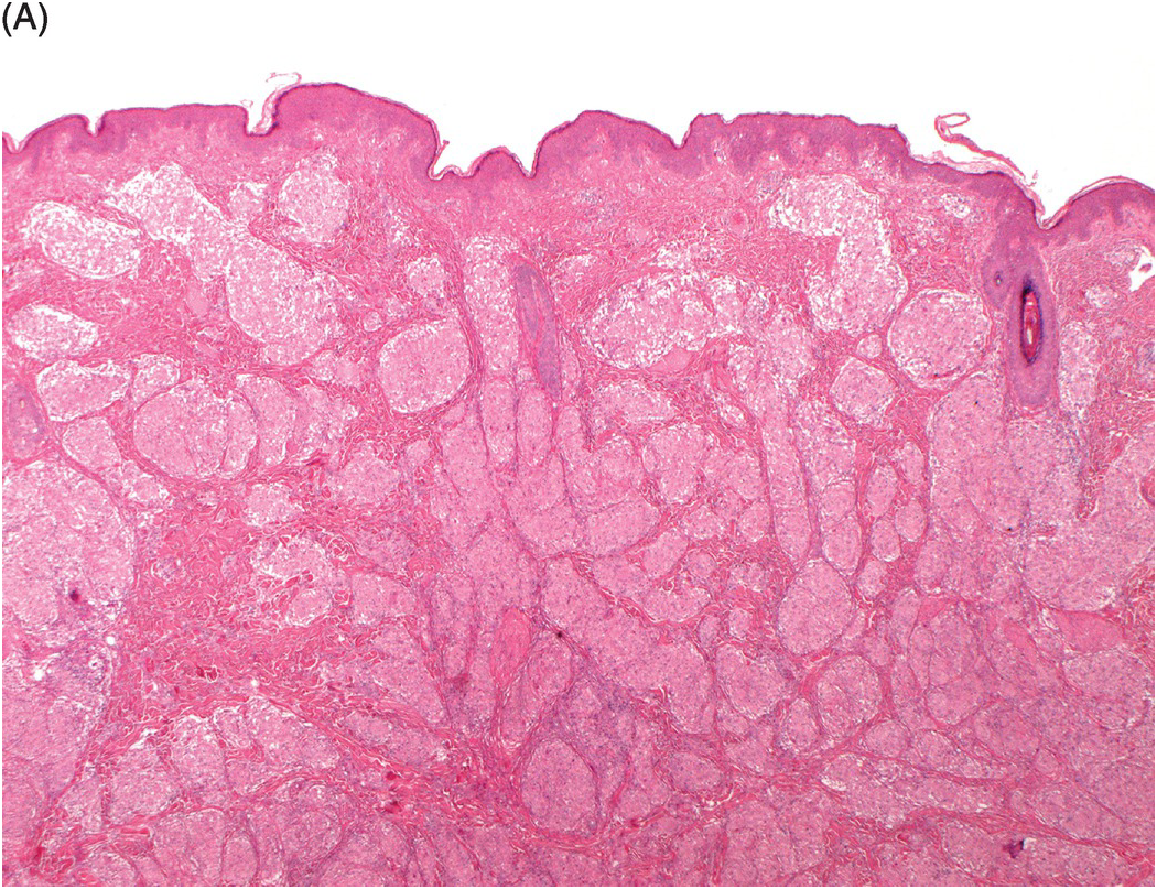 Erythema Annulare Centrifugum Histology