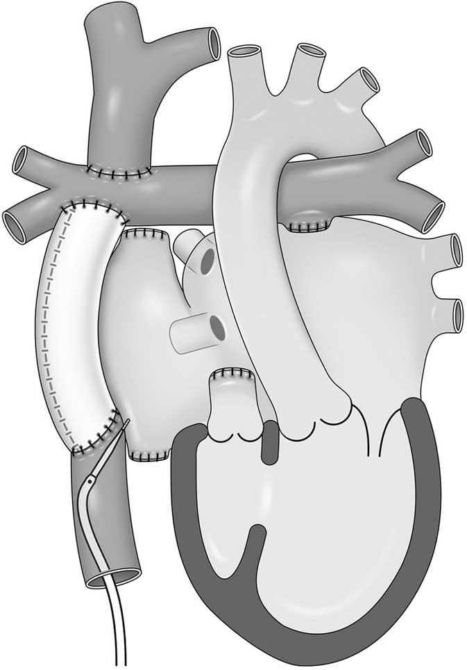 Static balloon atrial septostomy for the purpose of left heart ...