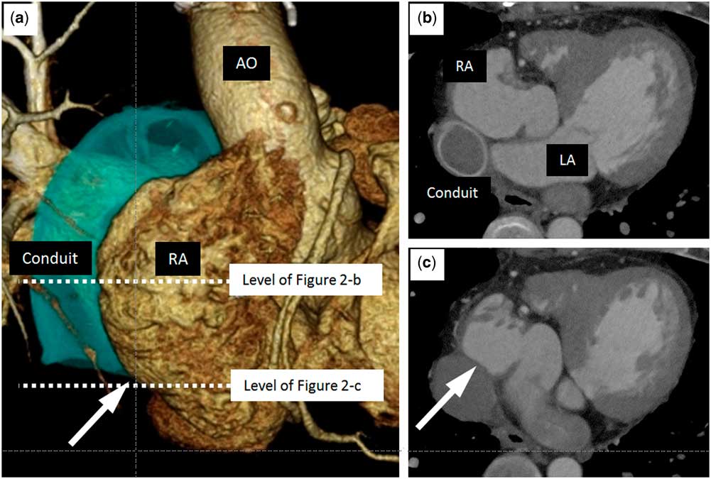 Static balloon atrial septostomy for the purpose of left heart ...