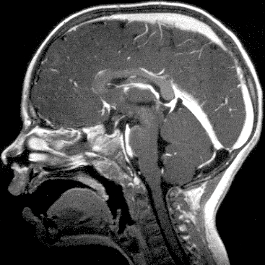 Posterior Fossa Craniotomy