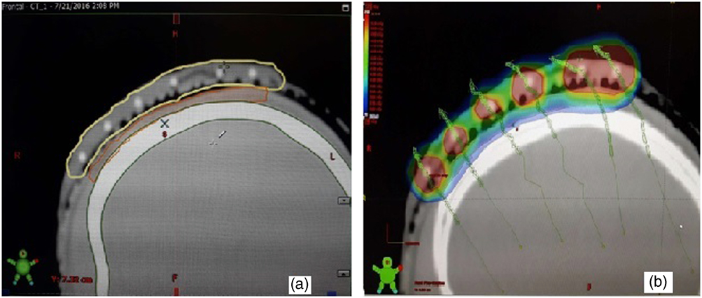 Dermatofibrosarcoma protruberans of the scalp treated with customised ...