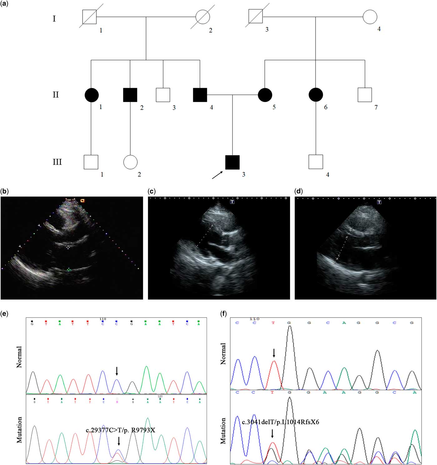 Whole-exome sequencing reveals doubly novel heterozygous Myosin Binding ...