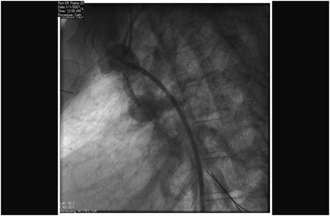 Single-centre experience in stenting arterial shunts for adult CHD ...