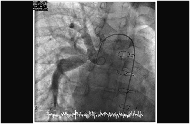 Single-centre experience in stenting arterial shunts for adult CHD ...