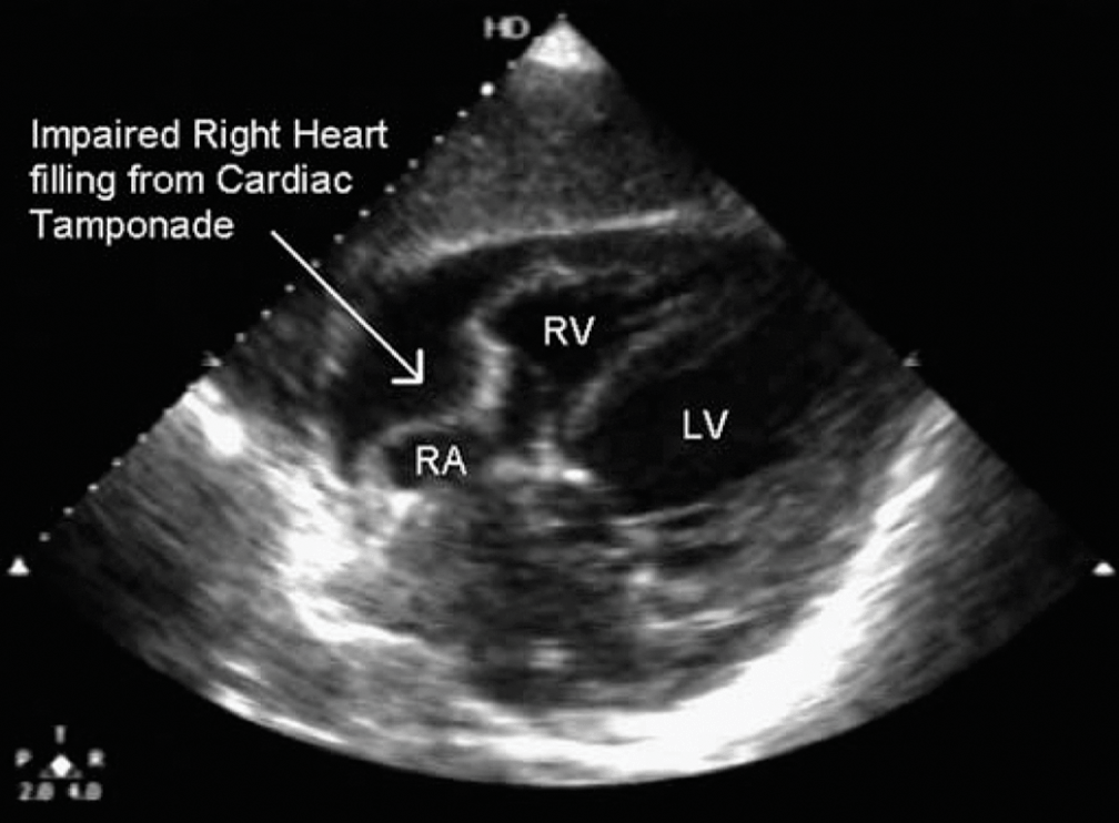 Cardiac Tamponade Echo Rv Collapse