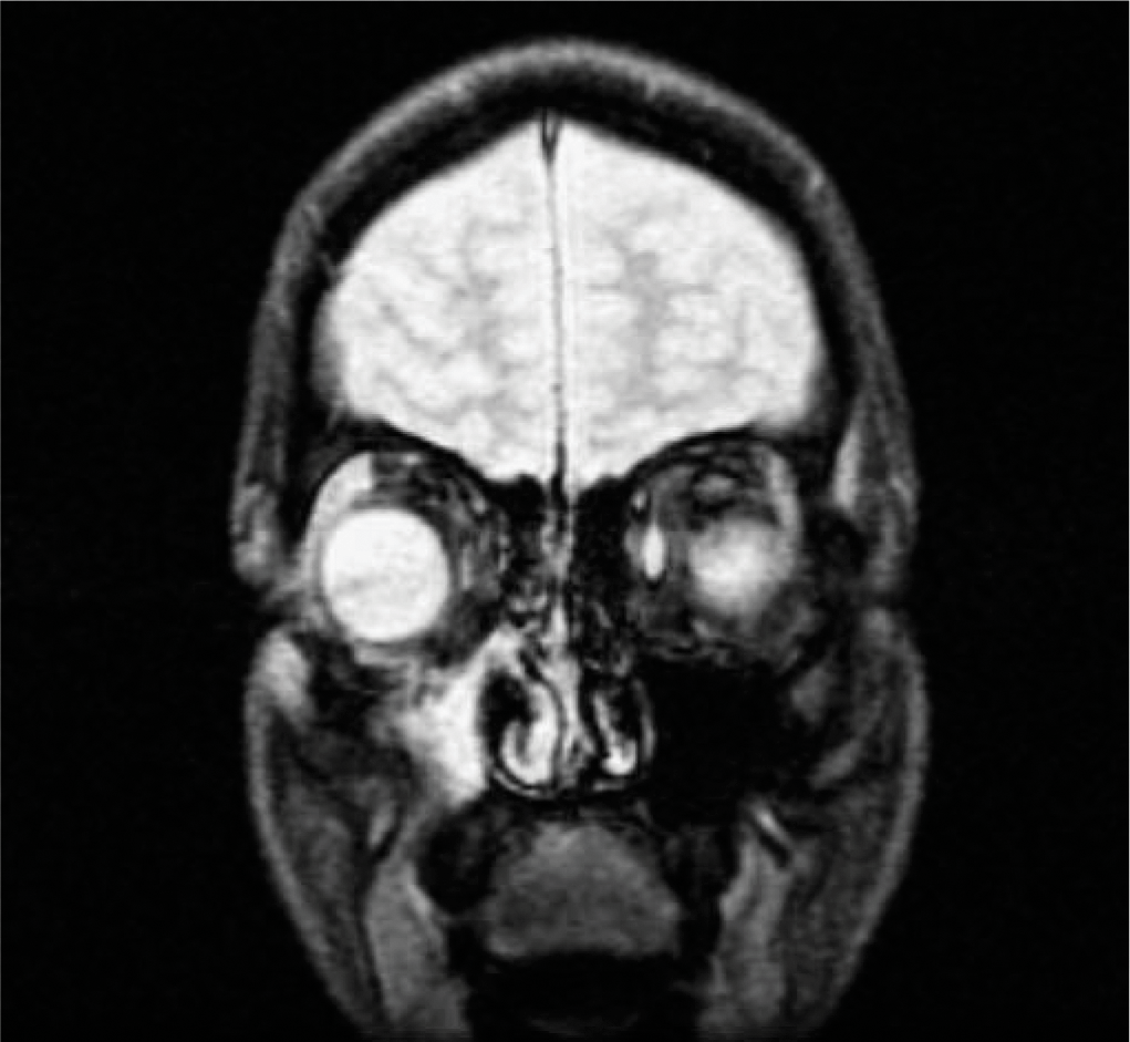Cor T2 Mri Of Brain