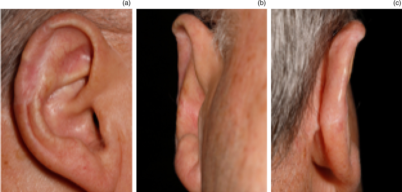 Single-stage helical rim reconstruction using a post-auricular ...
