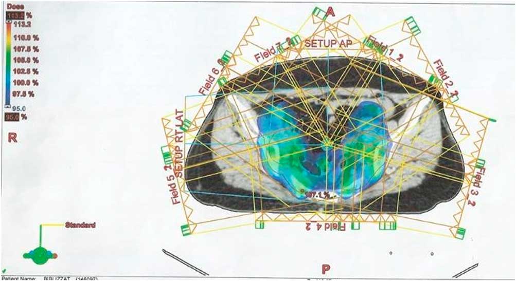Evaluation of various dose homogeneity indices for treatment of ...