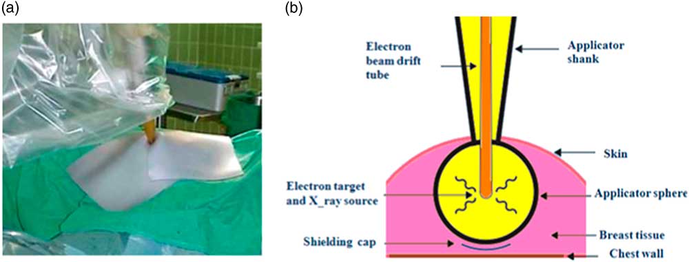 Breast intraoperative radiotherapy: a review of available modalities ...