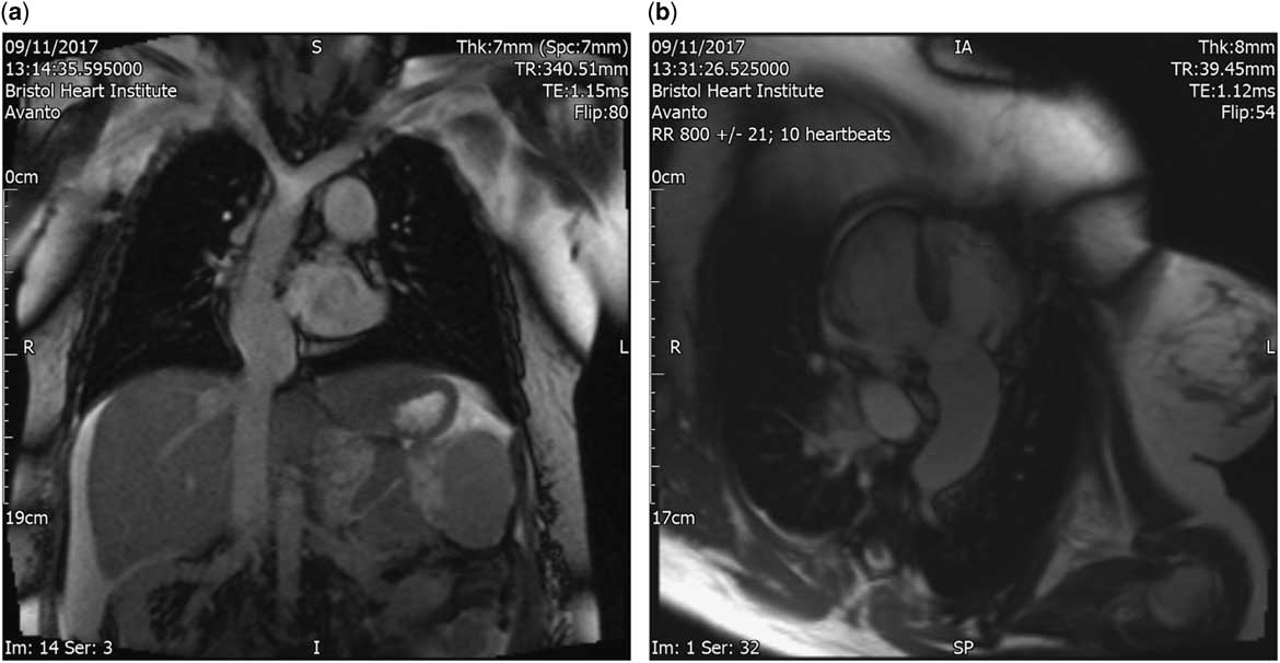 Success in a Fontan pregnancy: how important is ventricular function ...